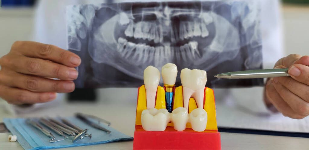 Dental Implants vs Dentures: Which Is Right For You?